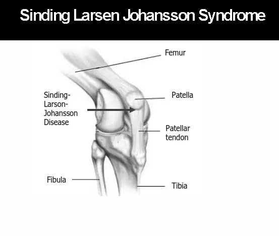 The Best Treatment for Sinding Larsen Johansson Syndrome at Home - Best ...
