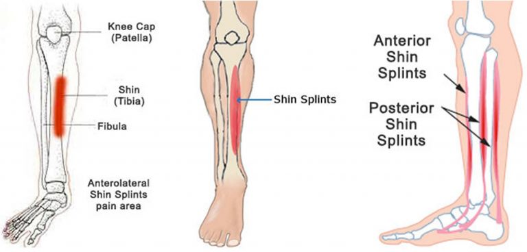 Shin Splints: A Helpful Guide for Home Treatment - Best Physical ...