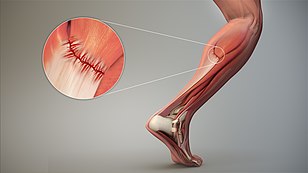 Calf Strain: A Helpful Guide for a Quick Recovery - Best Physical ...