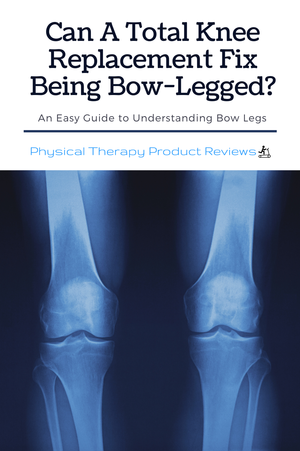 Can a Total Knee Replacement Fix Being Bow-Legged? - Best Physical ...