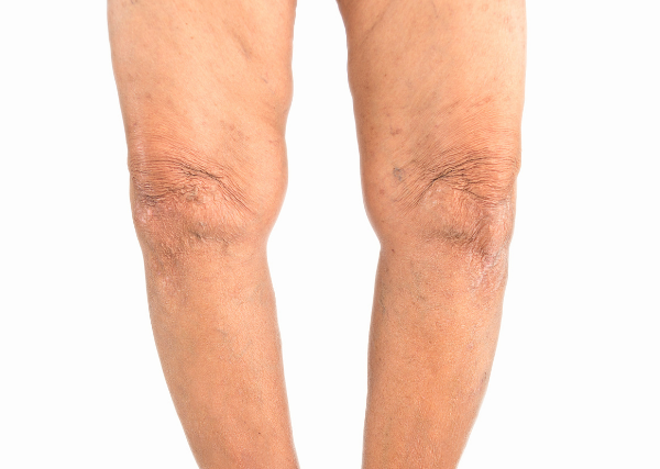 Can a Total Knee Replacement Fix Being Bow-Legged? - Best Physical ...