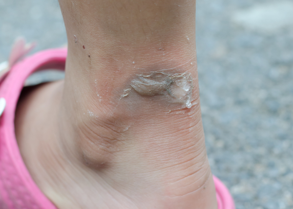 Running with an Ankle brace: When Should You Wear One?